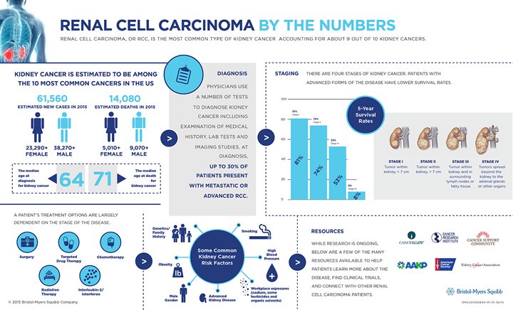 Renal cell carcinoma by the numbers (Infographic) – Baltimore Sun