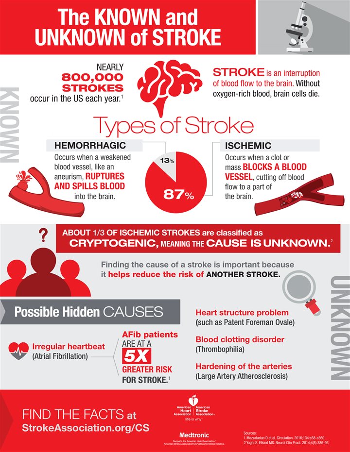 Known and unknown causes of stroke (Infographic) – Orlando Sentinel